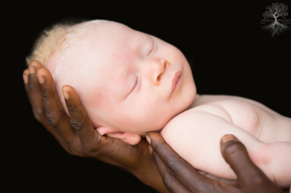 Birthing Stories Sharing Circle – Mothering & Albinism